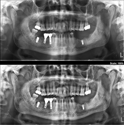 IdcImplant - Non restorable fractured lower right second molar ...